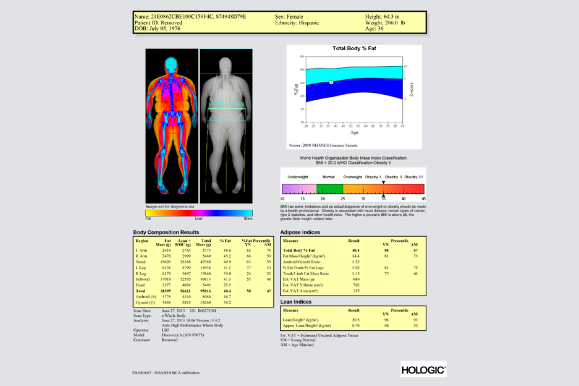 Horizon® DXA System Body Composition & Skeletal Health Solution by Hologic