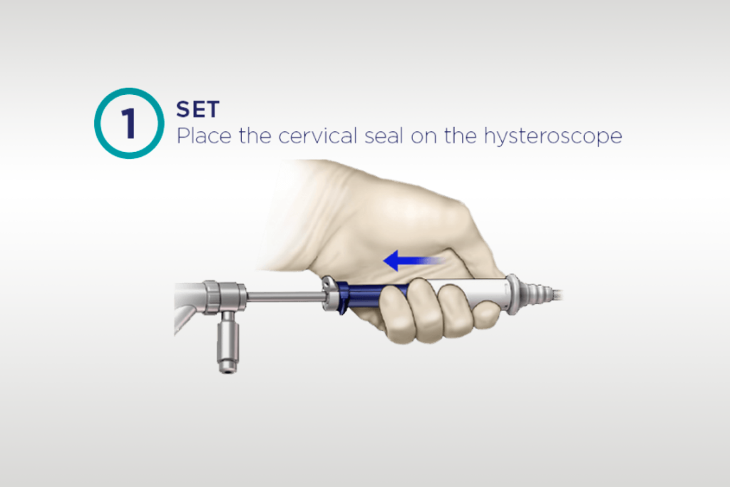 Omni® Lok Cervical Seal by Hologic UK
