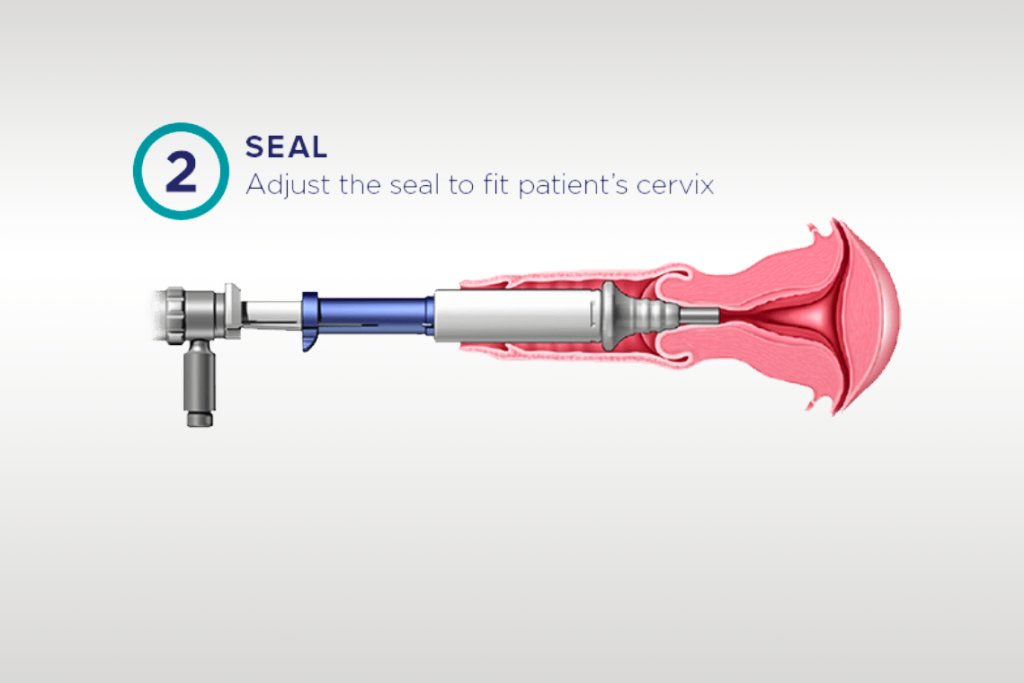 Omni® Lok Cervical Seal by Hologic UK