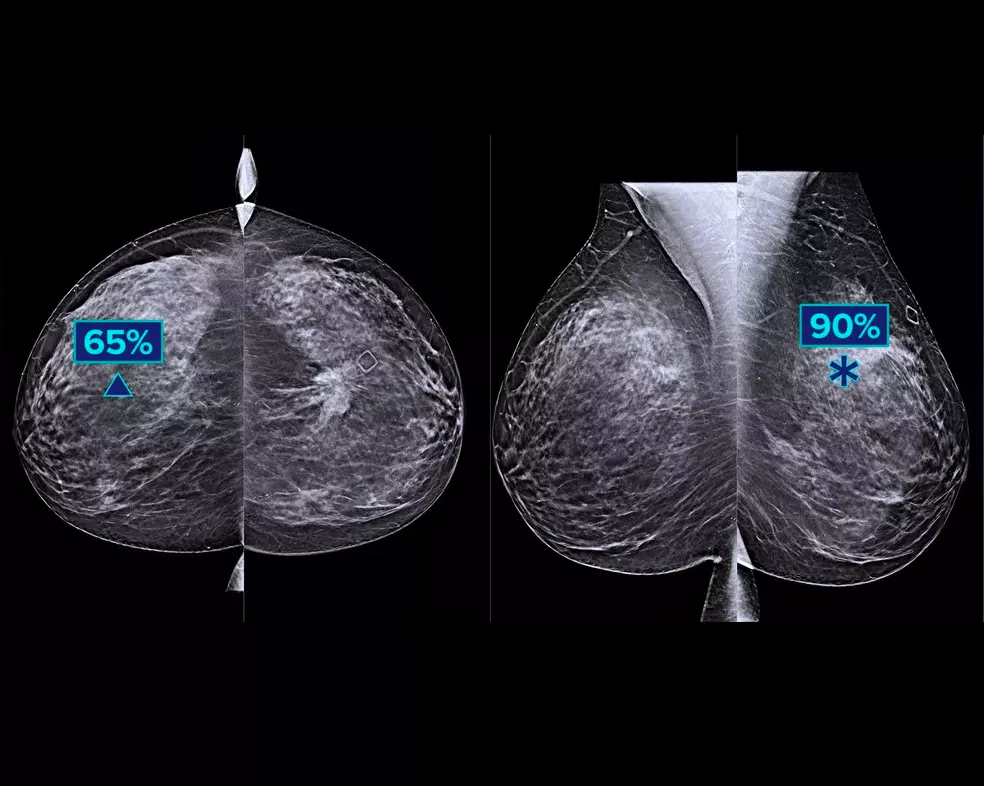 Genius AI™ Detection Technology | Advanced Imaging | Hologic® UK Genius AI™ Detection Technology | Advanced Imaging | Hologic® UK