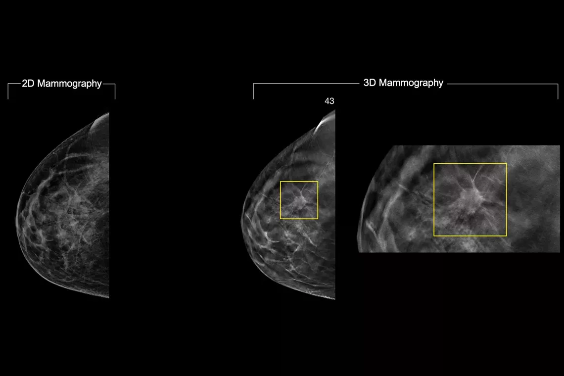 ImageChecker® 2D CAD Technology | Breast Imaging | Hologic® UK